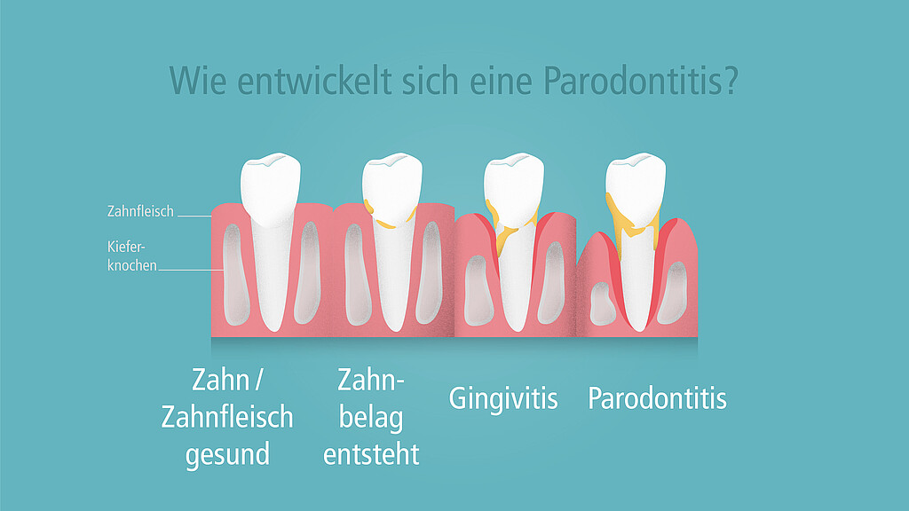 Zahnarzt Gütersloh Dr. Kirsch | Parodontologie